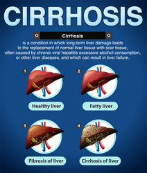 Stages of liver damage infographic Royalty Free Vector Image