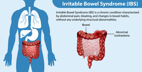 Irritable bowel syndrome ibs infographic Vector Image