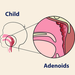 Adenoids Vector Images (over 320)
