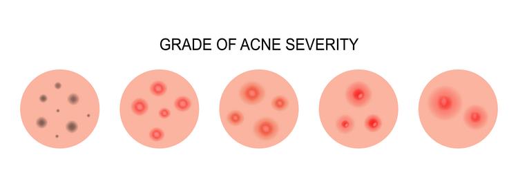 Acne Diagram Vector Images (over 490)