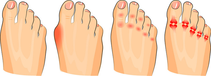 Inflammation Vector Images (over 23,000)