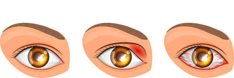 Conjunctivitis Vector Images (over 3,400)