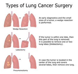 Four stages of lung cancer Royalty Free Vector Image