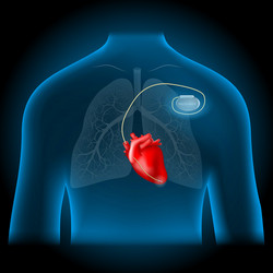 Artificial cardiac pacemaker heart implant Vector Image