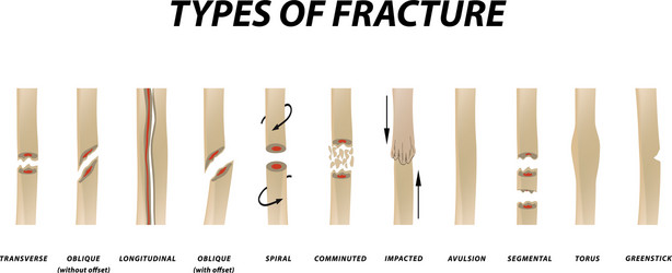 Types fracture bone set infographics Royalty Free Vector