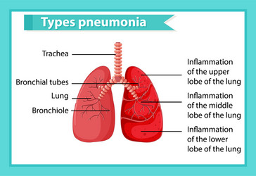 Lung diagram with pneumonia Royalty Free Vector Image