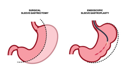 Gastrectomy and gastroplasty Royalty Free Vector Image