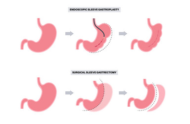 Gastrectomy and gastroplasty Royalty Free Vector Image