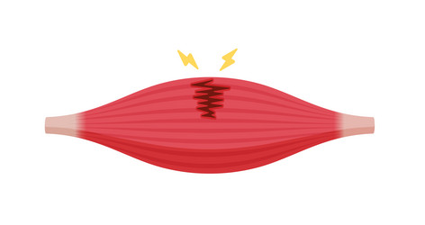 Muscle rupture partial and complete tears Vector Image