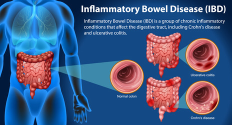 Inflammatory bowel disease ibd infographic Vector Image