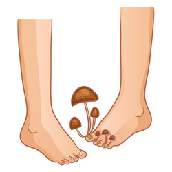 Foot with fungal infection Royalty Free Vector Image