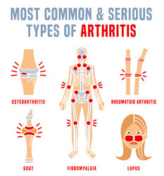 Gout arthritis infographic Royalty Free Vector Image