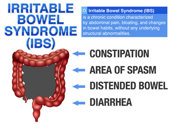 Irritable bowel syndrome ibs infographic Vector Image