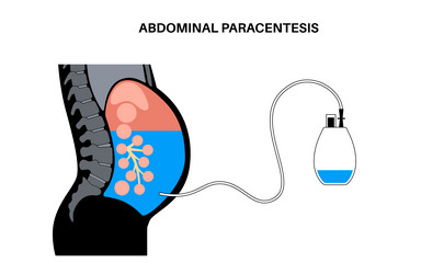 Abdominal paracentesis poster Royalty Free Vector Image