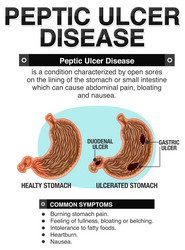 Peptic ulcer disease explained infographic Vector Image