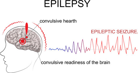 Epilepsy Vector Images (over 1,300)