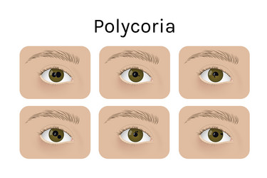 Realistic human normal eyes and with corectopia Vector Image