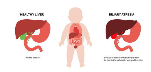 Biliary atresia disease Royalty Free Vector Image