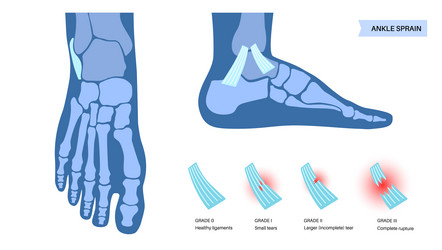 Sprained ankle injury Royalty Free Vector Image