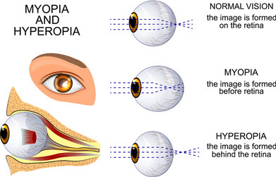 Optical human eye defects myopia and hyperopia Vector Image