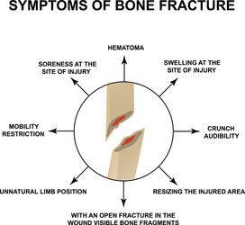 Bone Fracture Hematoma Vector Images (30)