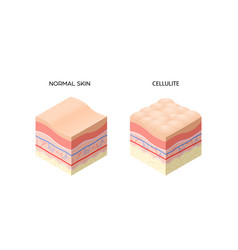 Set different types skin layers cross-section Vector Image