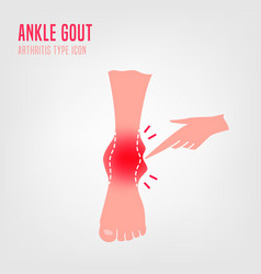 Gout arthritis infographic Royalty Free Vector Image