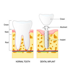 Teeth maquette structural elements of dental Vector Image