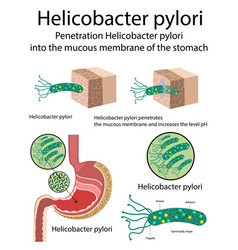 Helicobacter pylori medicine education diagram vec