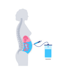 Abdominal paracentesis poster Royalty Free Vector Image