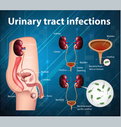 Informative urinary tract infections Royalty Free Vector