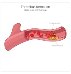 Blood cells thrombus infographics Royalty Free Vector Image