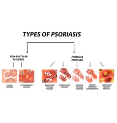 Cartoon hand with psoriasis or eczema Royalty Free Vector