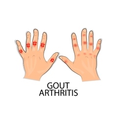 Gout arthritis infographic Royalty Free Vector Image