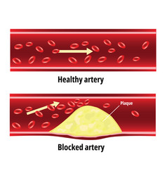 Arteries with clogged fat that causes blood clots Vector Image