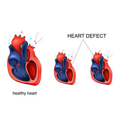 Heart and pacemaker cardiology Royalty Free Vector Image