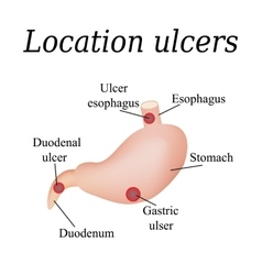 Stomach peptic ulcer charts Royalty Free Vector Image