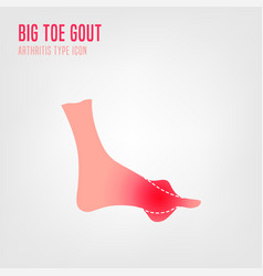 Gout arthritis infographic Royalty Free Vector Image