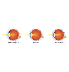 Optical human eye defects myopia and hyperopia Vector Image