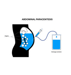 Abdominal paracentesis poster Royalty Free Vector Image