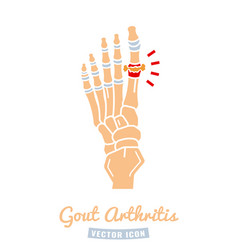 Gout arthritis infographic Royalty Free Vector Image