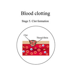 Arteries with clogged fat that causes blood clots Vector Image